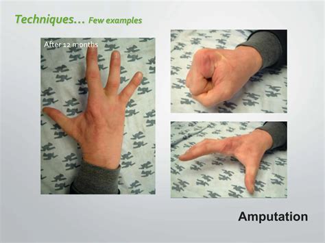 Amputation Orthopedics Mbbs With Types Pptx