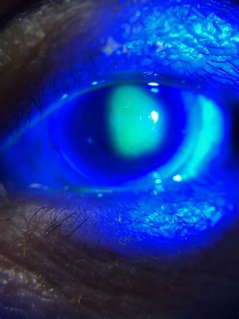 Fingernail Scratch Ophthalogix