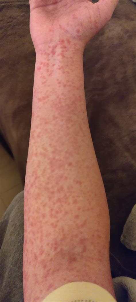 Strep Rash On Arms