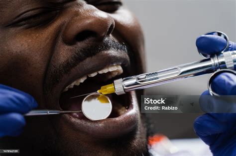 마취 주사기 주입 클로즈업 치과 의사는 병든 치아 치료를 위해 아프리카 남자의 입에 마취 주사기를 주사합니다 충치 치료 25 29세에 대한 스톡 사진 및 기타 이미지