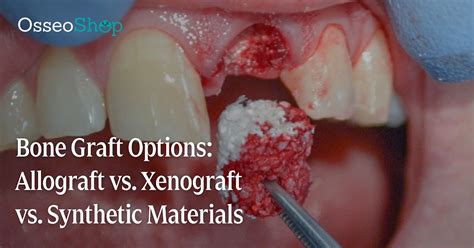 Bone Graft Options Allograft Vs Xenograft Vs Synthetic Materials