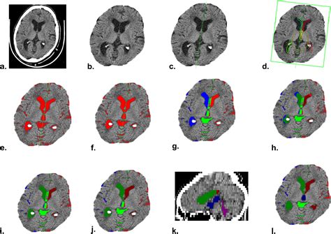 Automatic Model Guided Segmentation Of The Human Brain Ventricular System From Ct Images