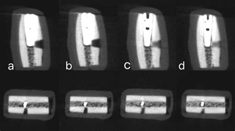 Sagittal And Axial Images With Simulated Peri Implant Fenestration