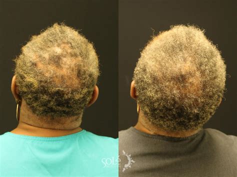 Prp Hair Loss Therapy Before And After Pictures Case 81 Tifton