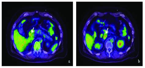 Distal Side Of An Extrahepatic Cholangiocarcinoma And Lymph Node Download Scientific Diagram