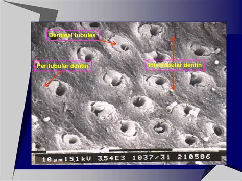 Dentinal Hypersensitivity Pdf