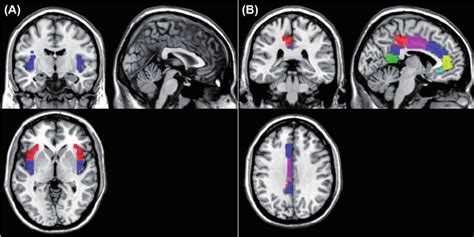 A Insula And Cingulate Cortex Parcellation In Neurological Download Scientific Diagram