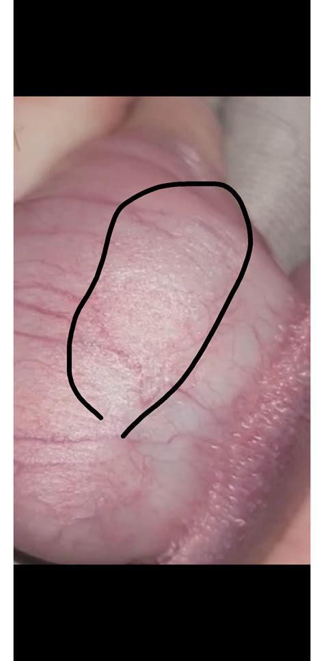 Anyone Had Skin Bumps Like This Under Foreskin Rgenitalhealth