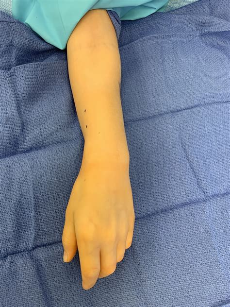 Forearm Synostosis Facts And My Approach To Treatment Congenital