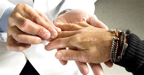 Understanding Scleroderma