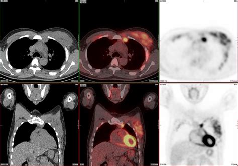 Hodgkins Lymphoma Of The Breast With Involvement Of The Brachial Plexus Applied Radiology