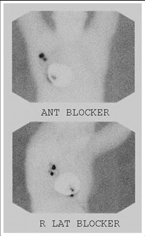 Table 1 From Administration Of Subcutaneous Buffered Lidocaine Prior To Breast