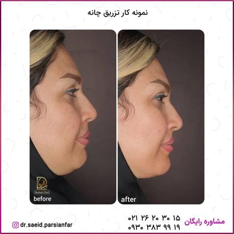 تزریق ژل لب و معایب و مزایای آن و ژل لب روسی با هزینه ژل