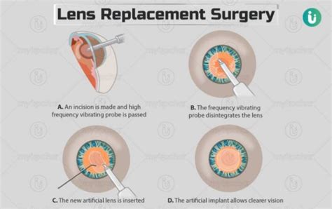 Guide To Intracapsular Cataract Extraction Icce Obn