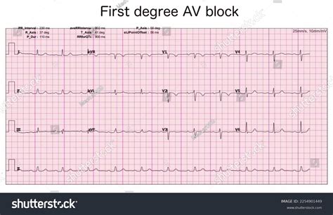 Electrocardiogram Show First Degree Av Block Stock Illustration 2254901449 Shutterstock