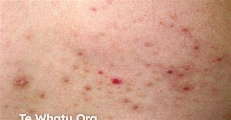 Pityriasis Lichenoides Image
