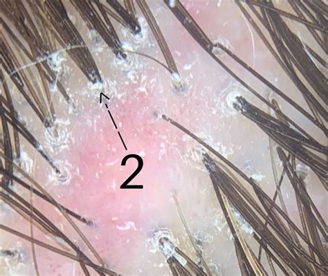 Trichoscopy Of Folliculitis Decalvans — Donovan Hair Clinic