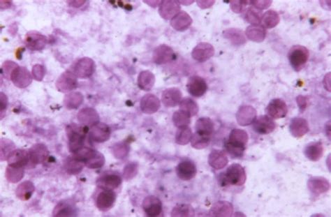 Pneumocystis Jirovecii Pneumocystis Pneumonia Pcp Concise Medical