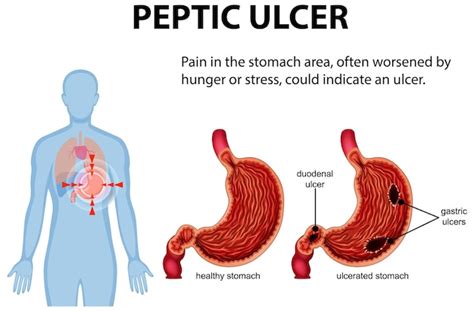 Anatomy Of Peptic Ulcer