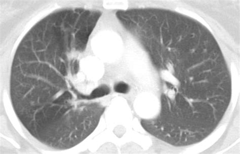 Chest Ct Suggests Atresia Of The Rul Posterior Segment Download Scientific Diagram Chest Ct Suggests Atresia Of The Rul Posterior Segment Download Scientific Diagram