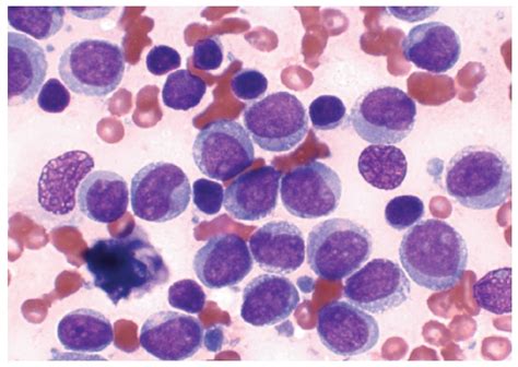 Bone Marrow Aspirate Smears Showing Large Blasts With Monocytic