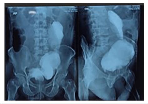 Cysto Urethrography Vcug Showing A Large Diverticulum With Narrow Download Scientific Diagram