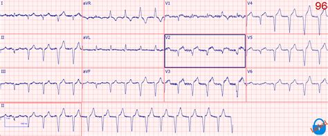 Is This Stemi Lvh Early Repolarization Dr Smiths Ecg Blog