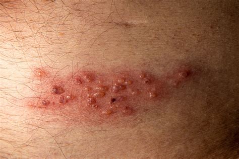 Zona Symptômes Causes Traitements Maquestionmedicale