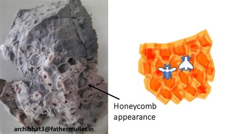 Pathology Of Bronchiectasis Pathology Made Simple