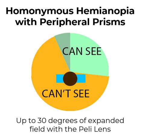 Prisms In Your Peripheral Vision At Lisa Castillo Blog