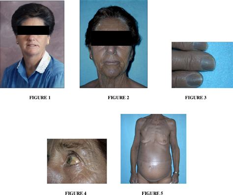 Figure 4 From Diffuse Melanosis And Ascites Due To Metastatic Malignant Melanoma Semantic Scholar