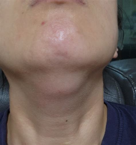 턱 밑 목 밑에 혹이 느껴져요 지식in