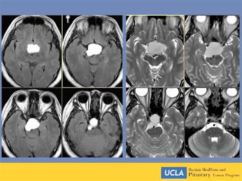 Pituitary Tumor Mri