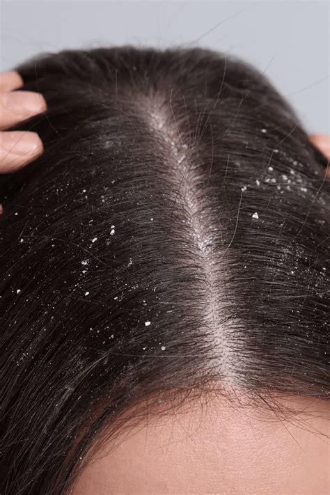 Dry Scalp Or Dandruff Heres How To Tell The Difference — Haiirology