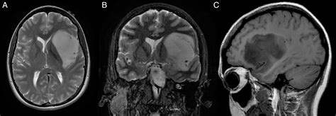 Surgical Paradigms In Diffuse Low Grade Glioma Insular Glioma Case Illustration Canadian