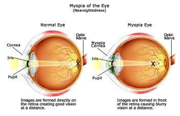 Myopia Symptoms Causes Diagnosis And Treatment Natural Health News