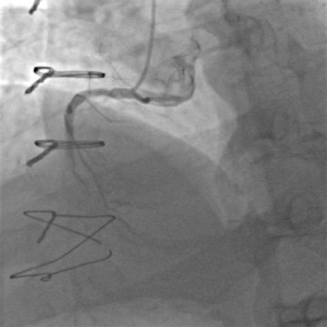 Angiogram Projection Lao 5° Cra 0° Patent Lita To Lad Ostial
