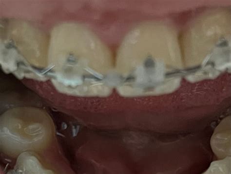 앞니에 불투명하고 동그랗게 있는거 뭔가요 지식in