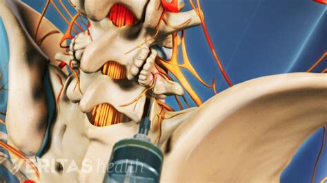 Medial Branch Block Video Spine Health