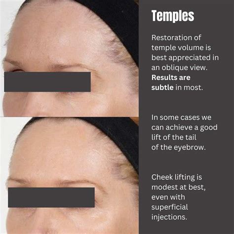 Temple Fillers Dr Davin Lim