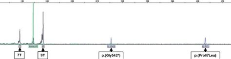 Electropherogram Showing Genotyping Results For Our Patient She Was A Download Scientific