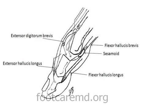 Big Toe Arthritis Hallux Rigidus Footcaremd Artofit