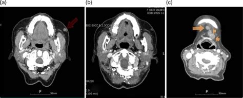 A Ct Before Radiotherapy An Arrow Showed Subcutaneous Lymph Node Download Scientific