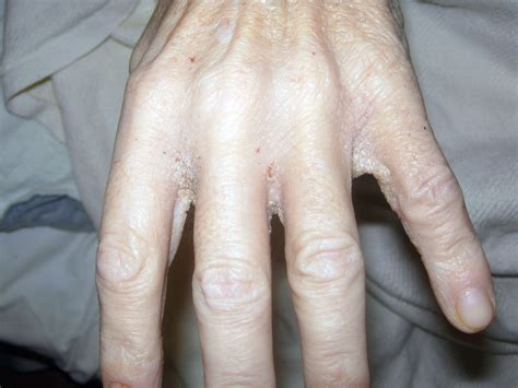 Mild Scabies Rash