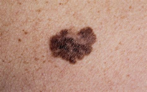 Melanoma Mole Look Like And Can Not Be A