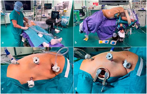 Surgical Technique And Implementation Of Total Minimally Invasive