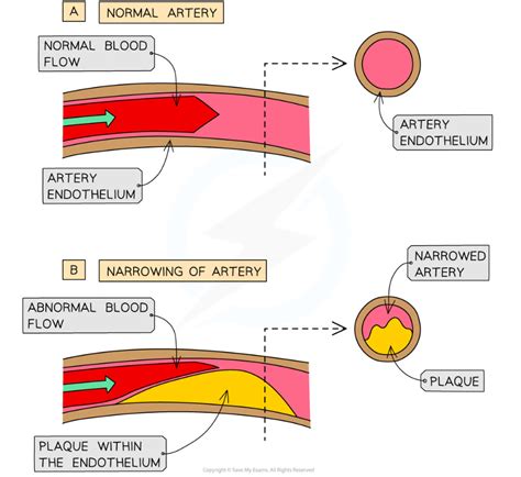 Edexcel A SNAB A Level Biology 复习笔记1 1 7 Atherosclerosis 翰林国际教育