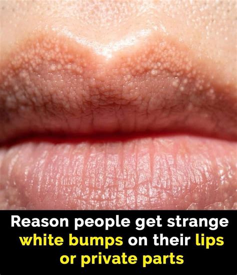 White Bumps On Private Parts Causes Treatment When To Worry