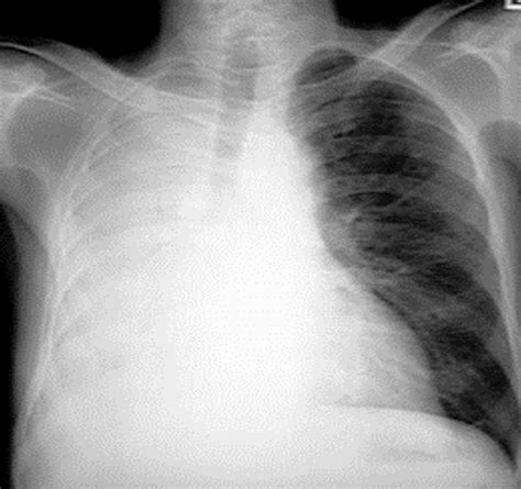 What Does This Patients Cxr Show A Pneumothorax On The Right Side B Atelectasis On The Right