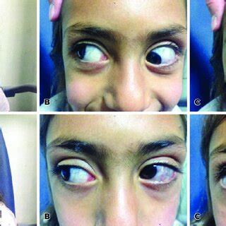 A Patient Seventh Case In Table 1 With Brown Syndrome In The Left